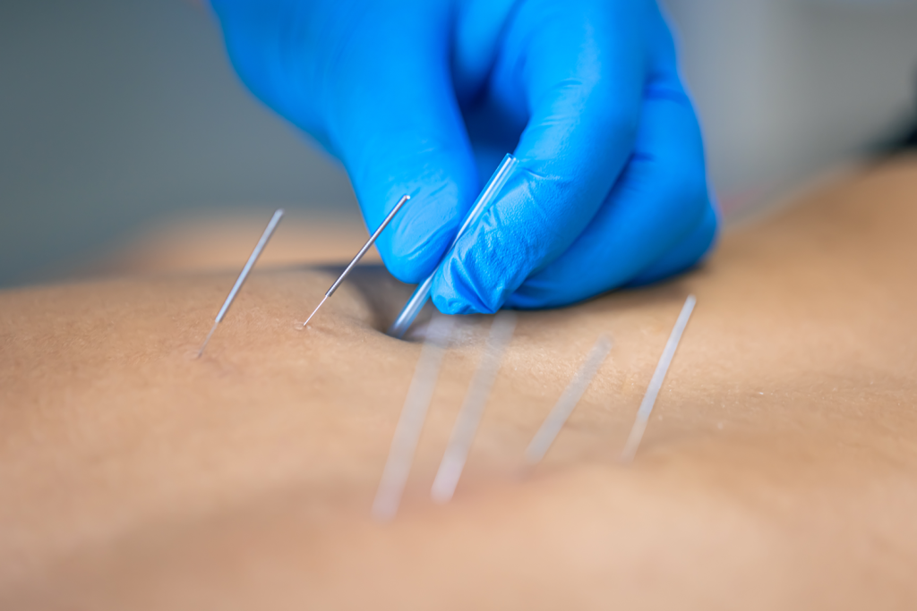 Holistic Beauty: The Intersection of Cosmetic Acupuncture and Modern ...